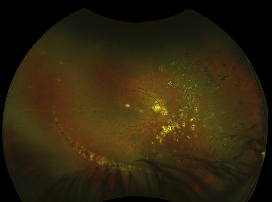 Scarring from the Valley - Canadian Retina Society