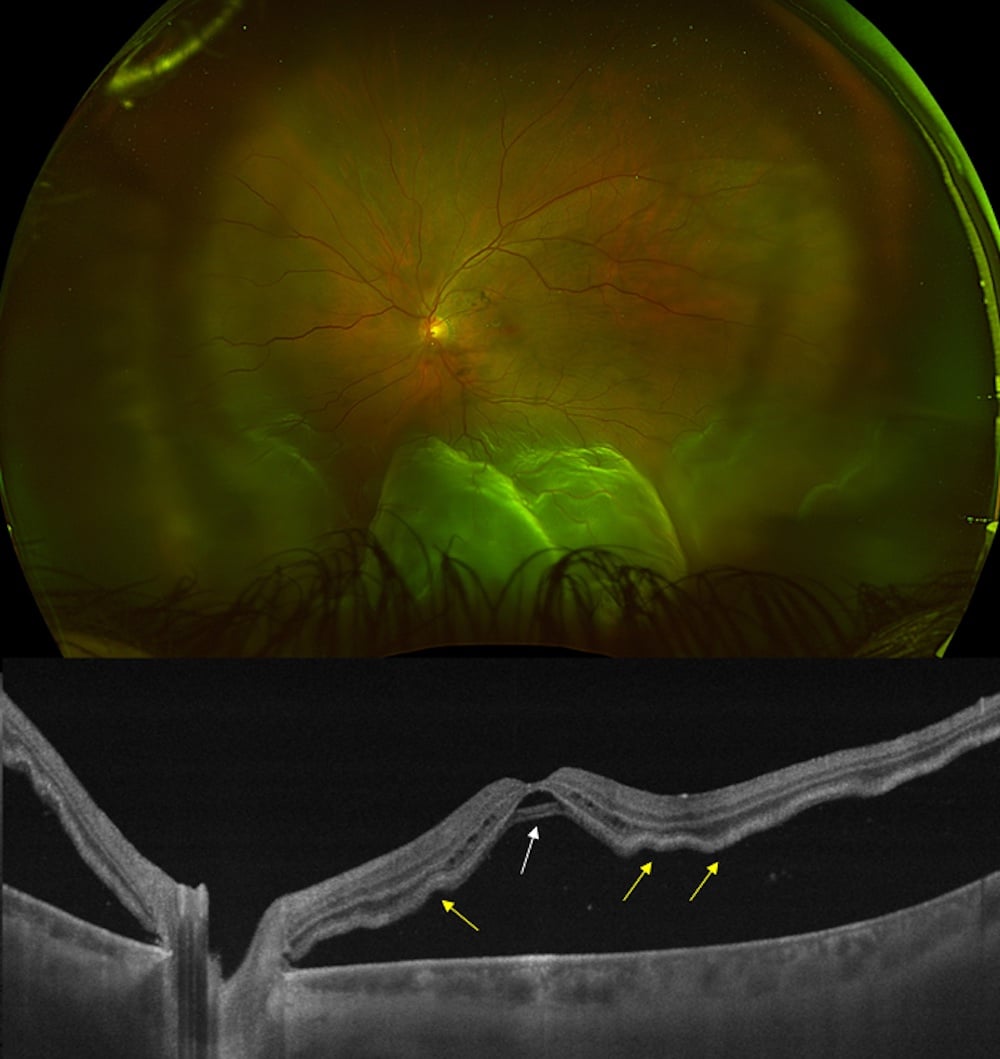 A Novel Finding in Fovea-off Rhegmatogenous Retinal Detachment: A Bacillary Layer Detachment ...