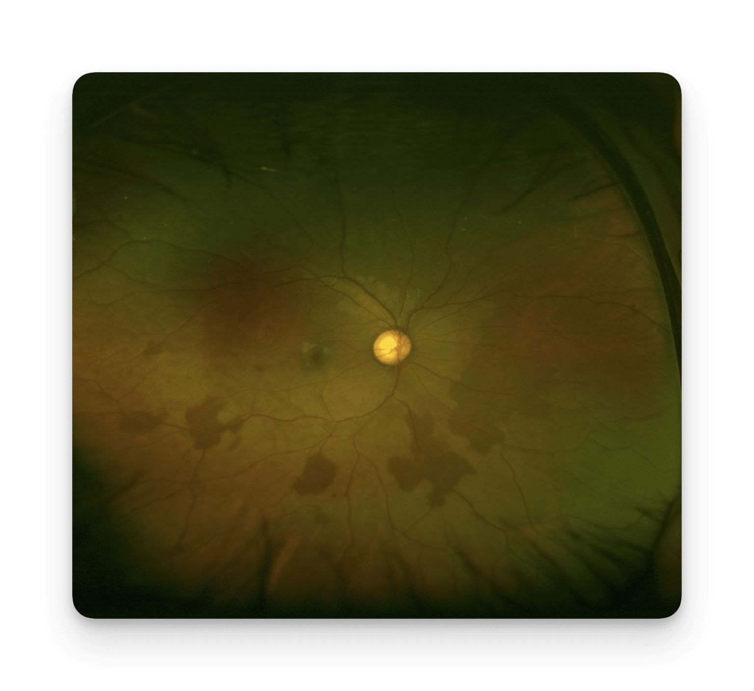 Dark without Pressure Lesions - Canadian Retina Society