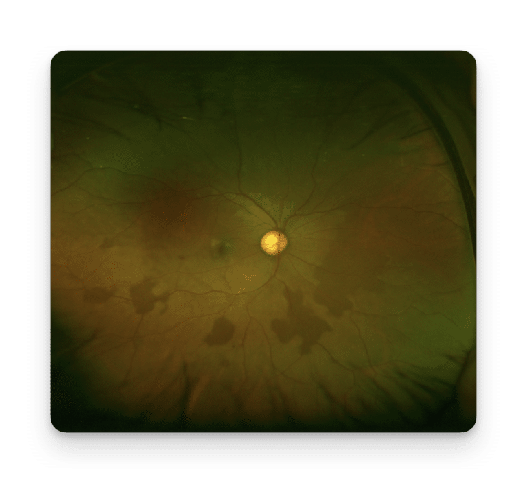 Dark without Pressure Lesions - Canadian Retina Society