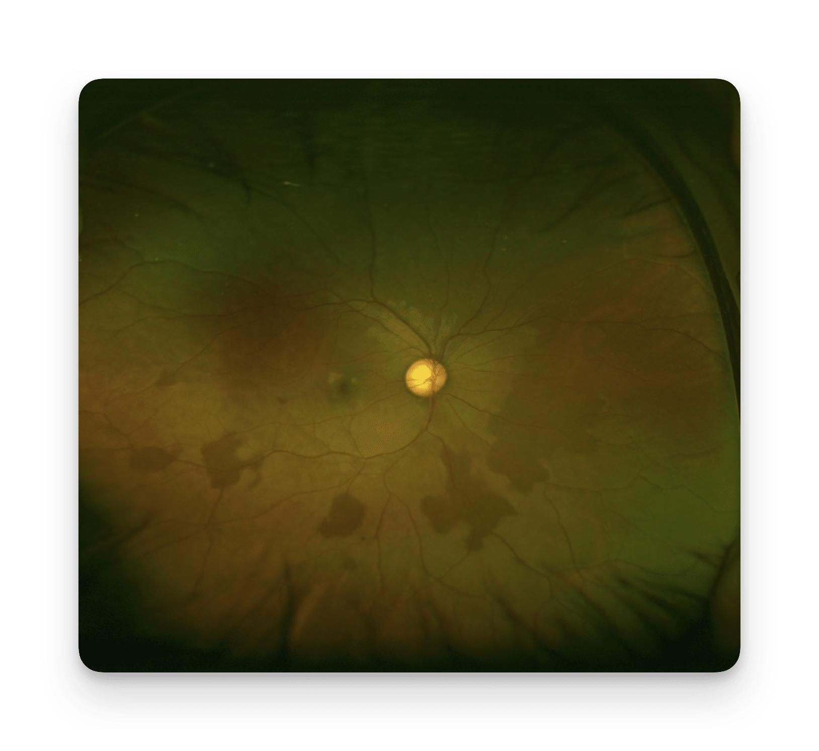 Dark without Pressure Lesions - Canadian Retina Society