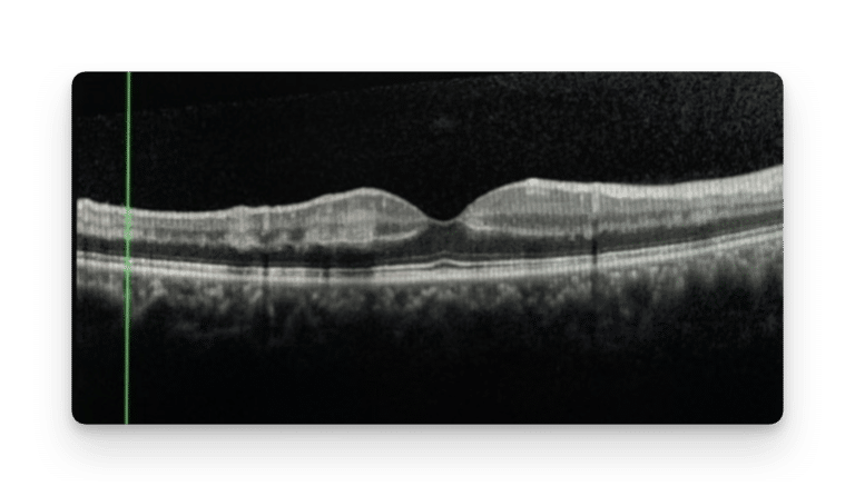Dark without Pressure Lesions - Canadian Retina Society