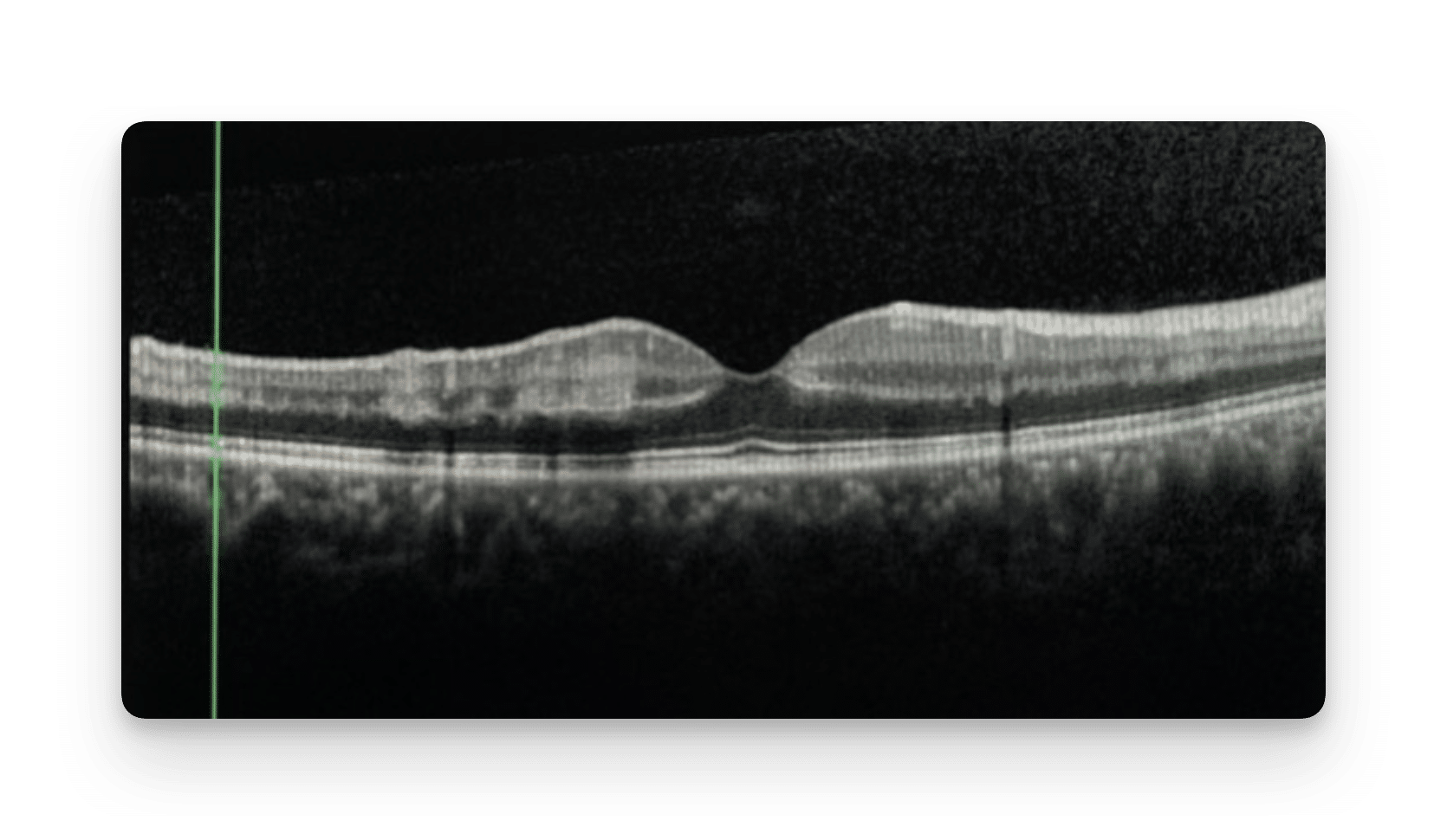Dark without Pressure Lesions - Canadian Retina Society