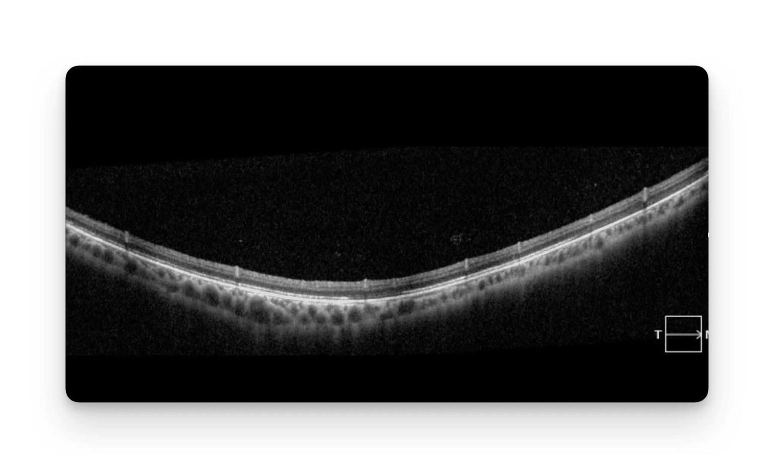 Dark without Pressure Lesions - Canadian Retina Society
