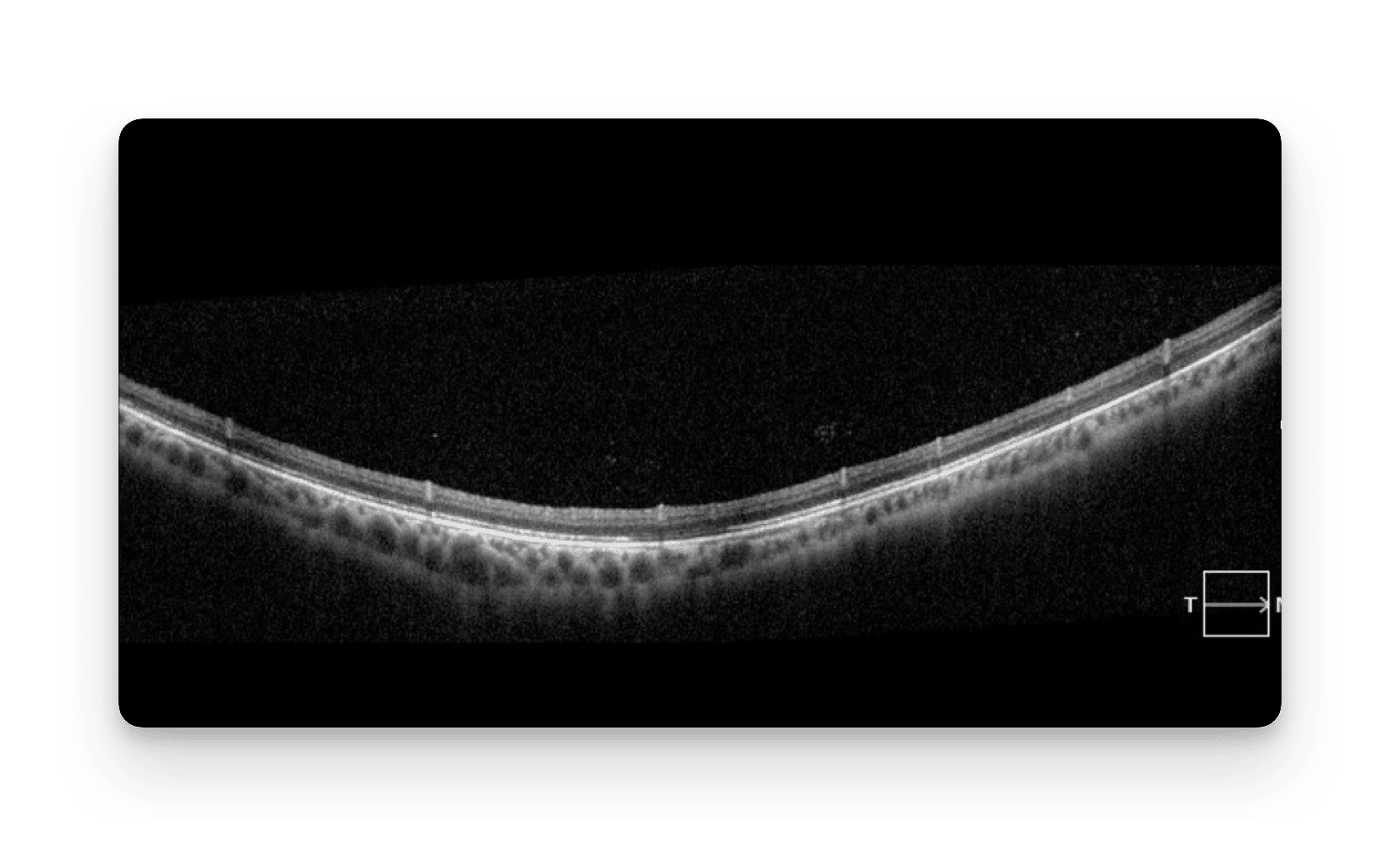 Dark without Pressure Lesions - Canadian Retina Society