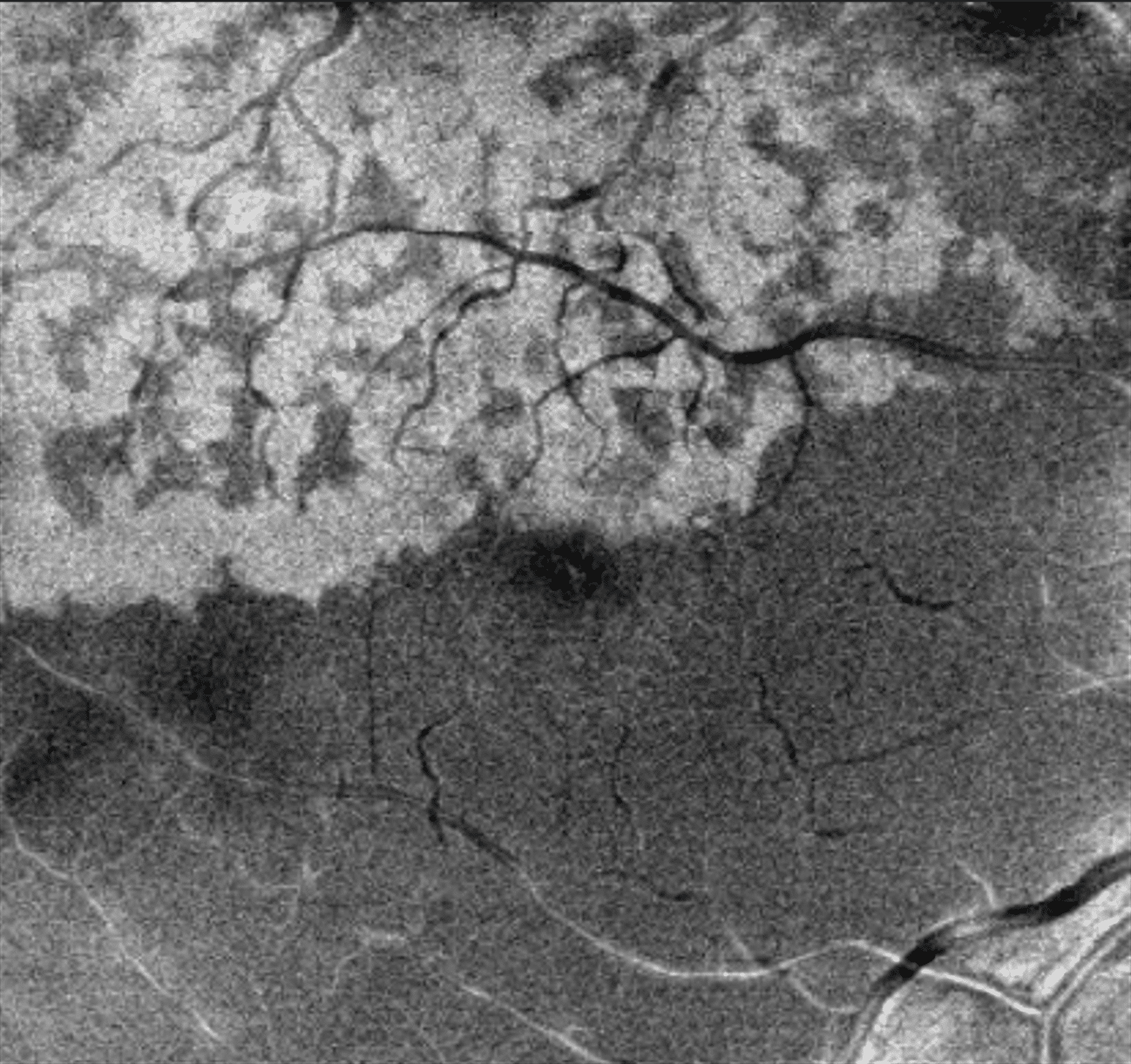 Perivenular PAMM - Canadian Retina Society